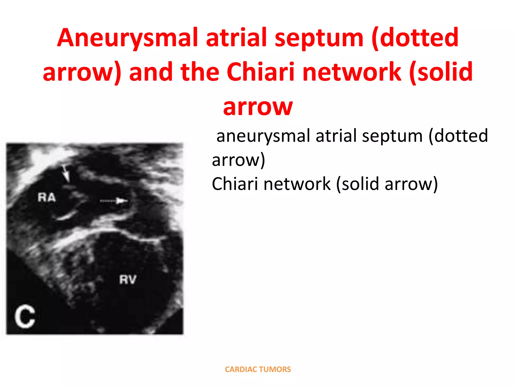 Cardiac tumors | PPTX