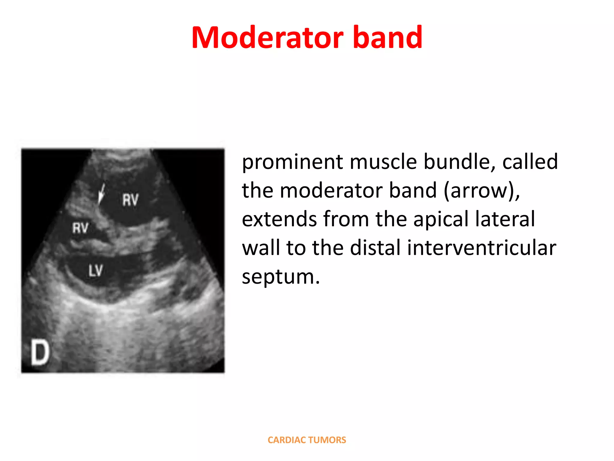 Cardiac tumors | PPTX