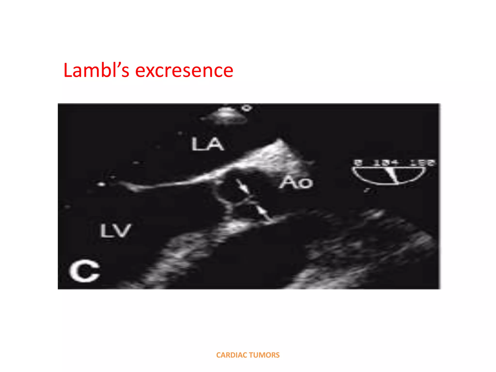 Cardiac tumors | PPTX