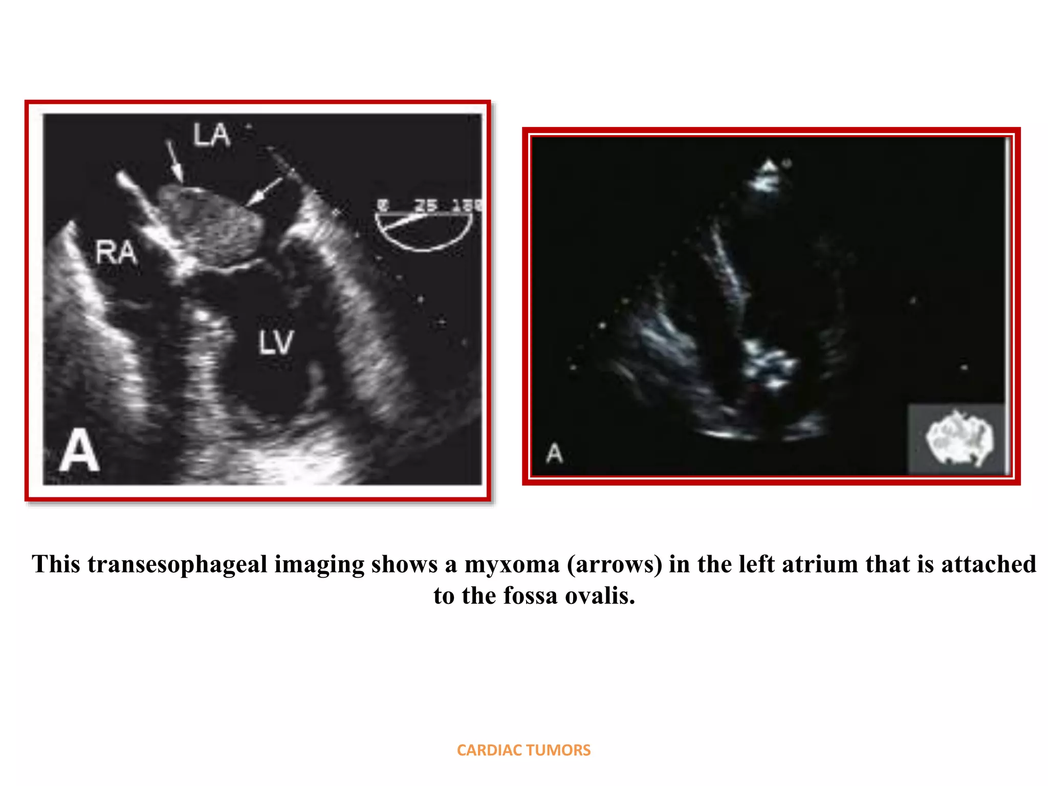 Cardiac tumors | PPTX
