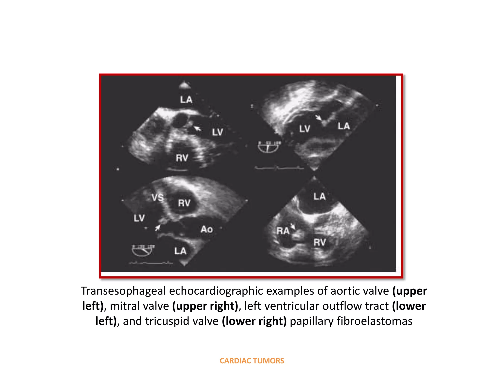 Cardiac tumors | PPTX