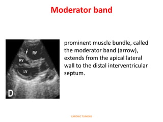Cardiac tumors | PPT