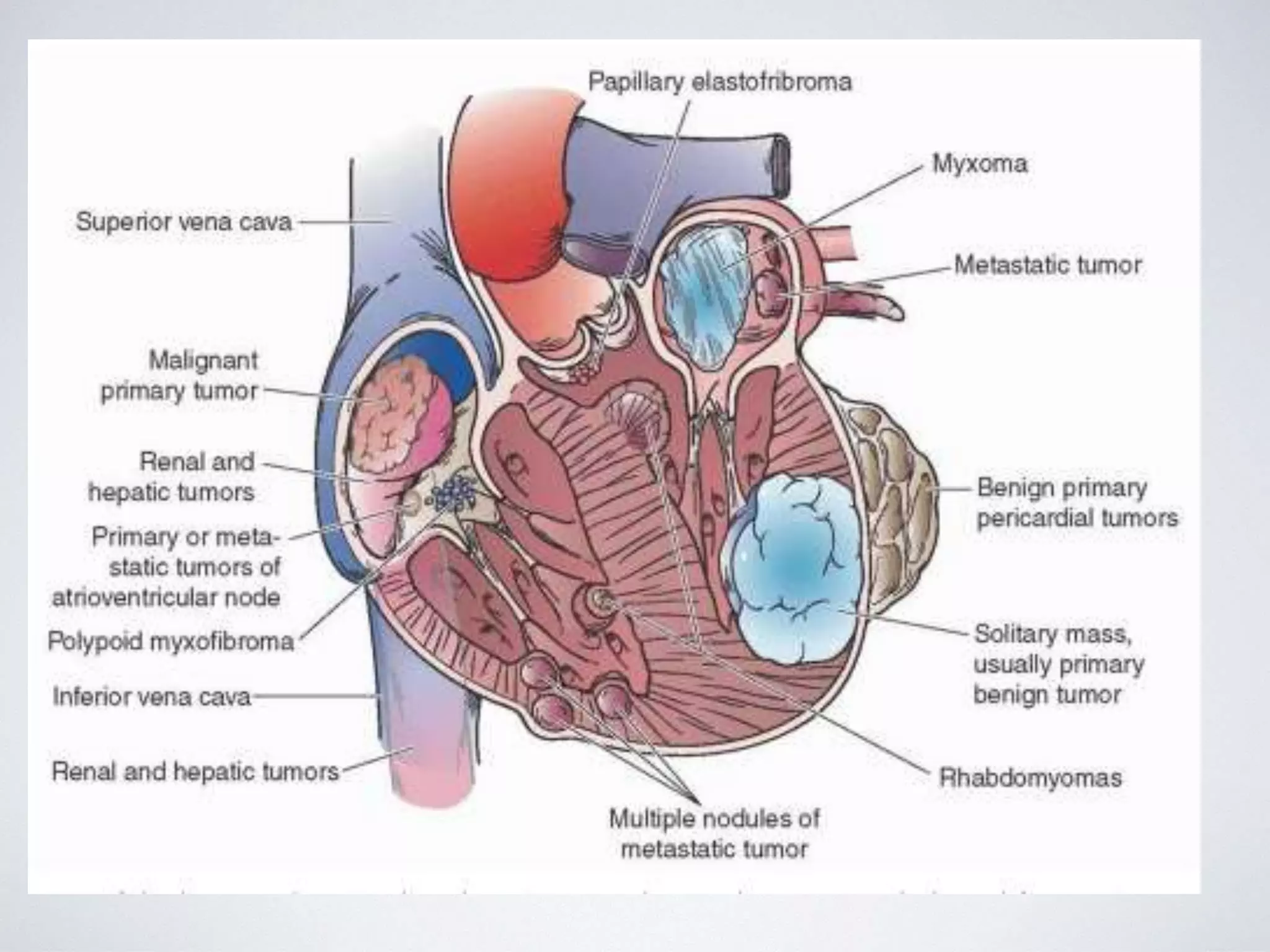 cardiac tumours.pptx