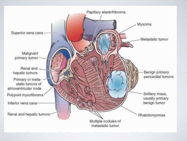 cardiac tumours.pptx | Heart and Cardiovascular Diseases | Diseases and ...