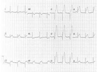 Cardiac vector and axis | PPTX