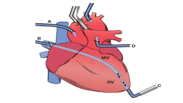 Cardiac Venting .pptx | Heart and Cardiovascular Diseases | Diseases ...