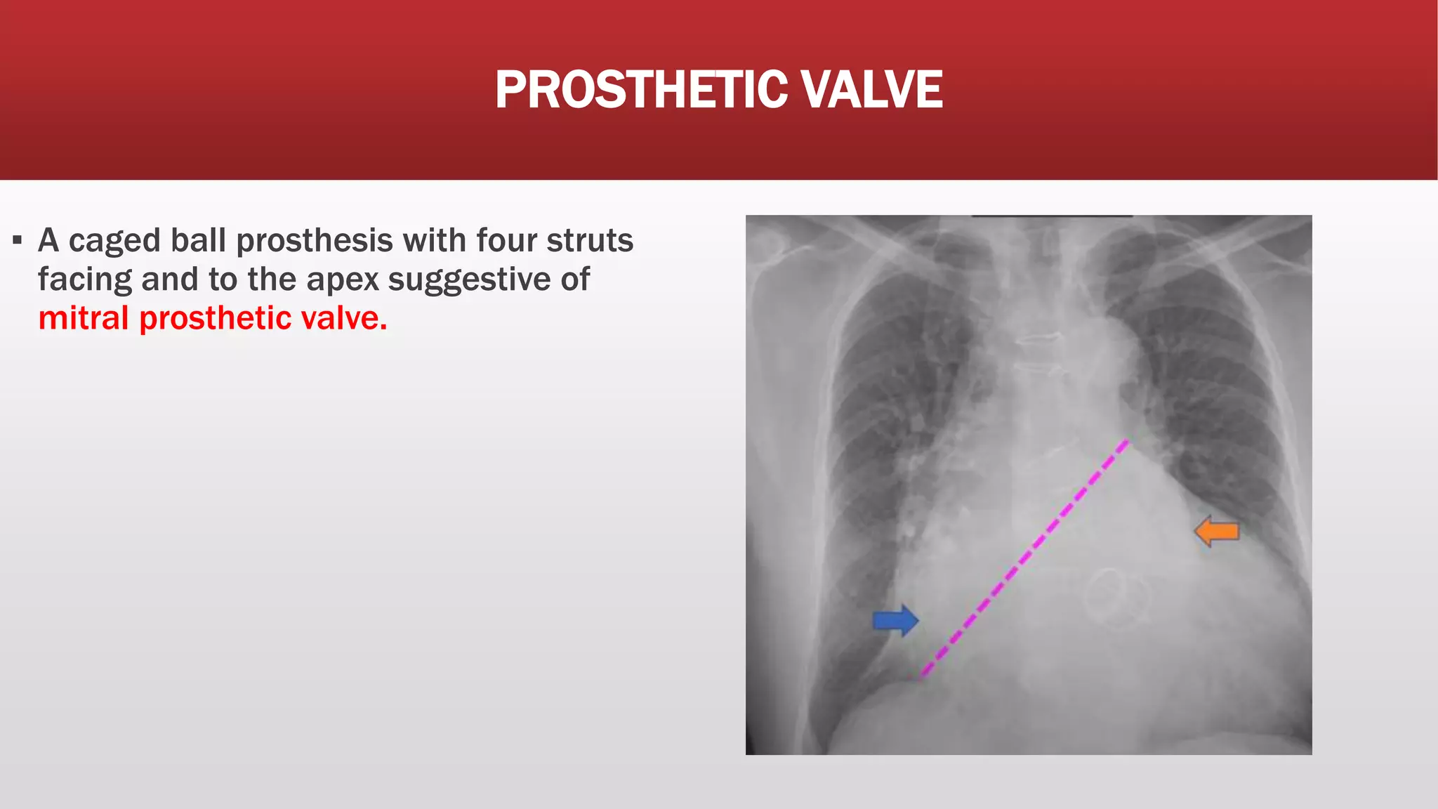 Cardiac X-ray .pptx