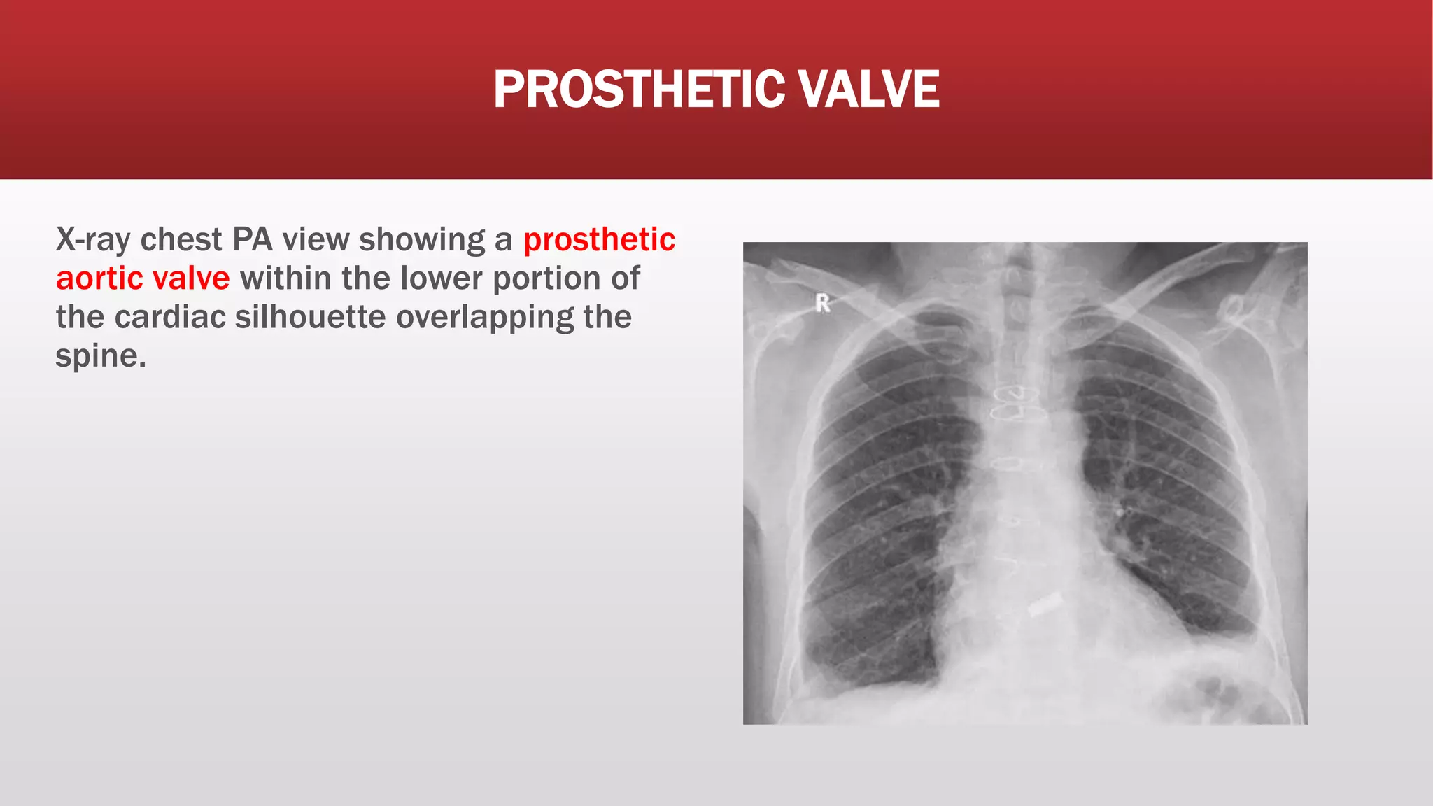 Cardiac X-ray .pptx | Lung and Respiratory Health | Diseases and Conditions