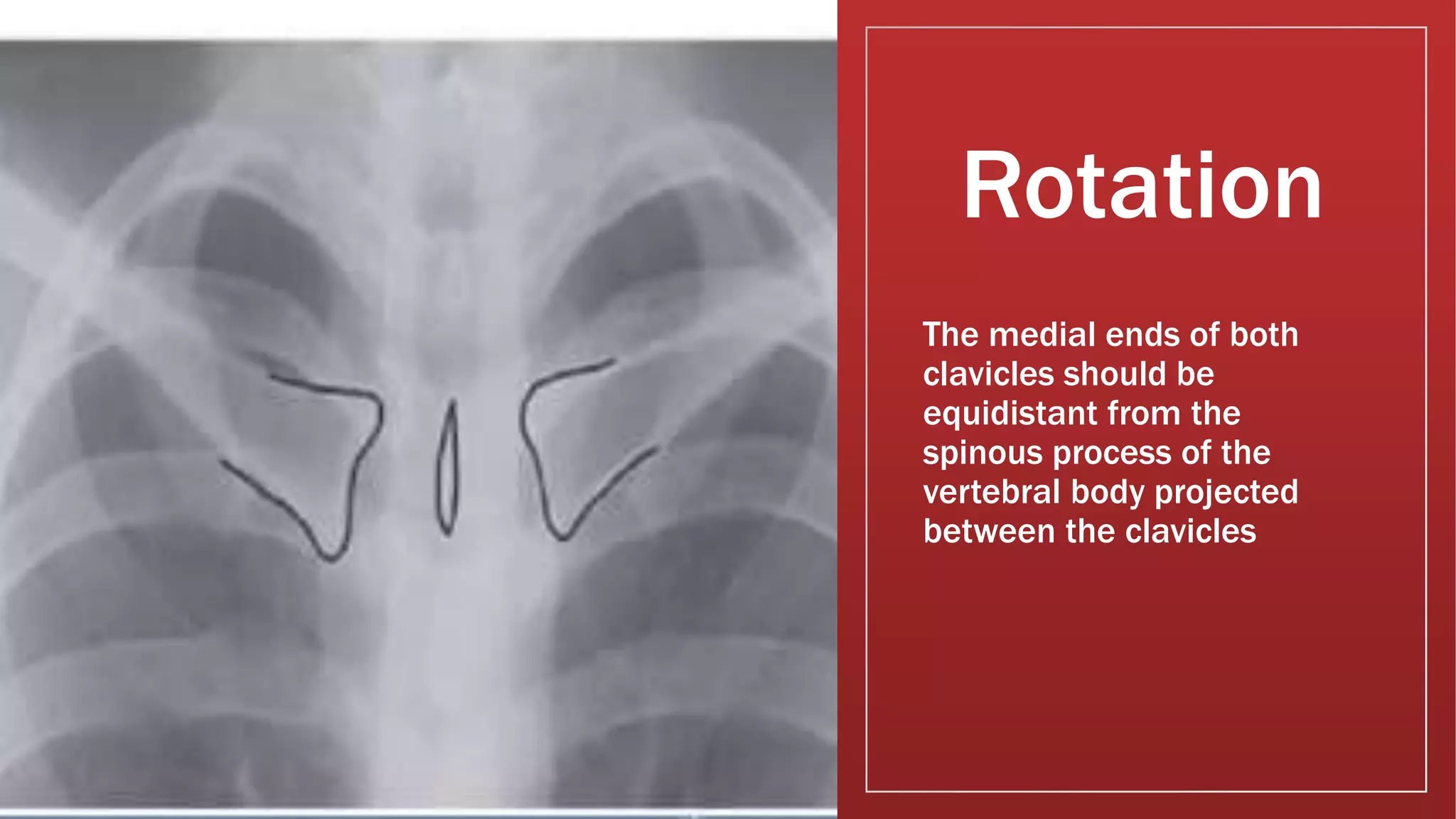Cardiac X-ray .pptx
