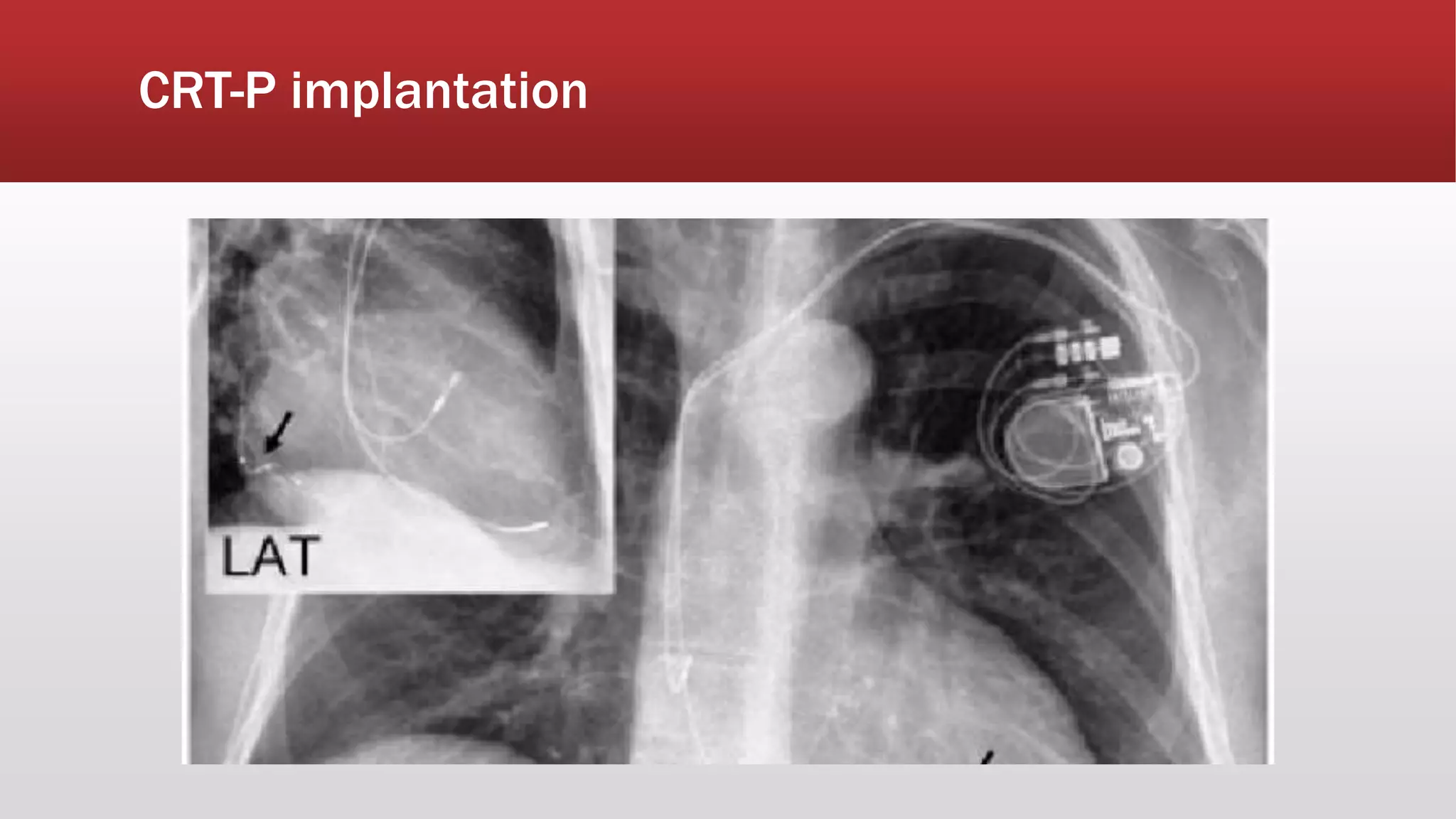 Cardiac X-ray .pptx
