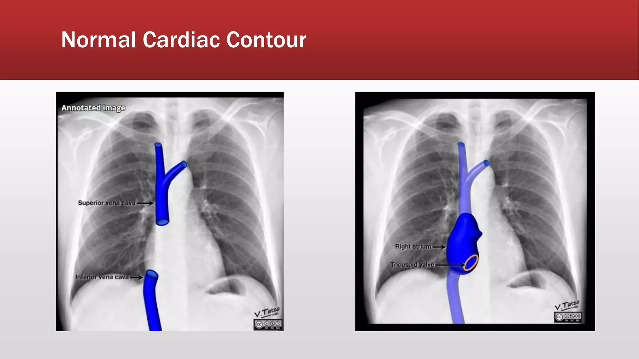 Cardiac X-ray .pptx