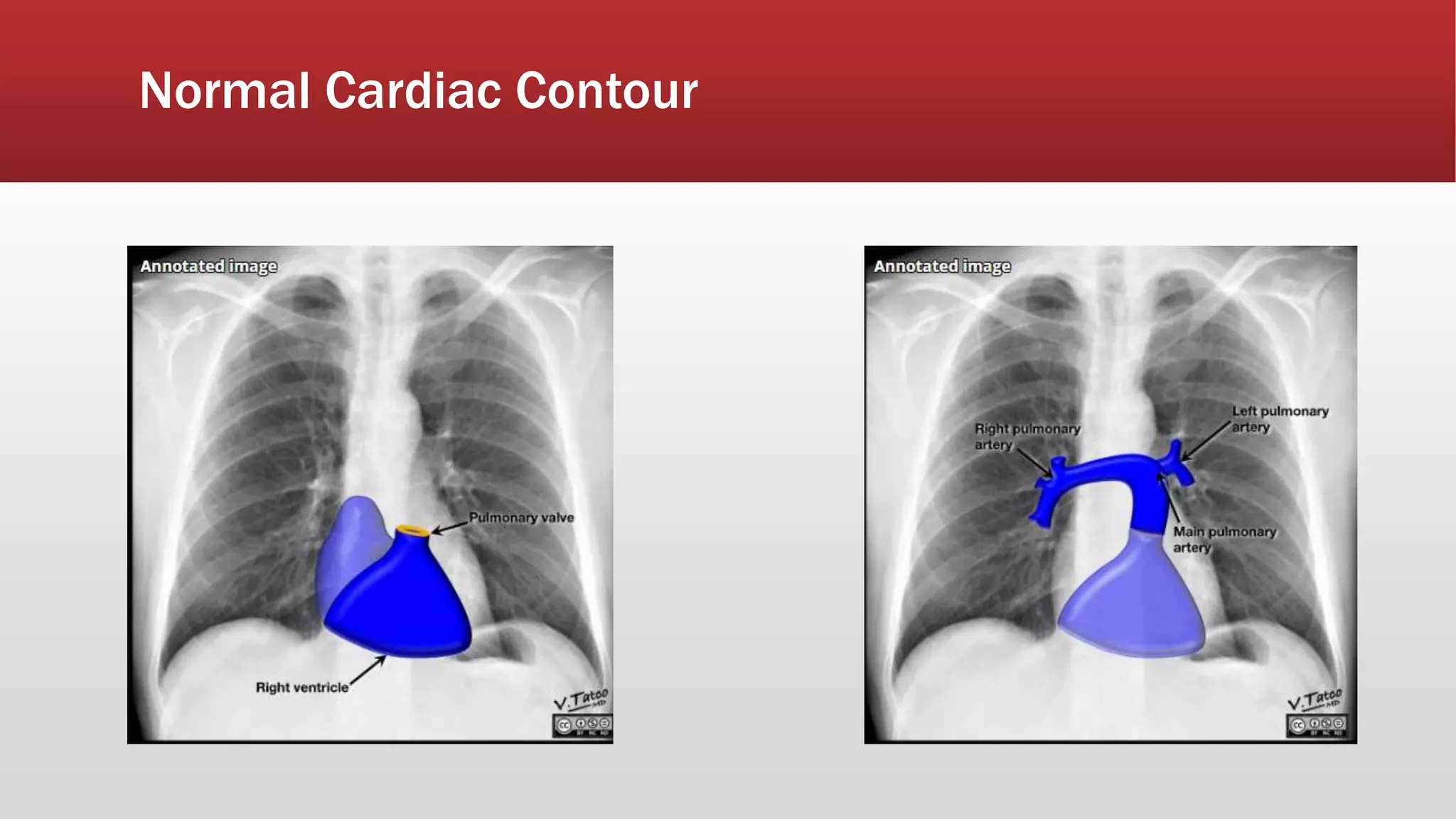 Cardiac X-ray .pptx