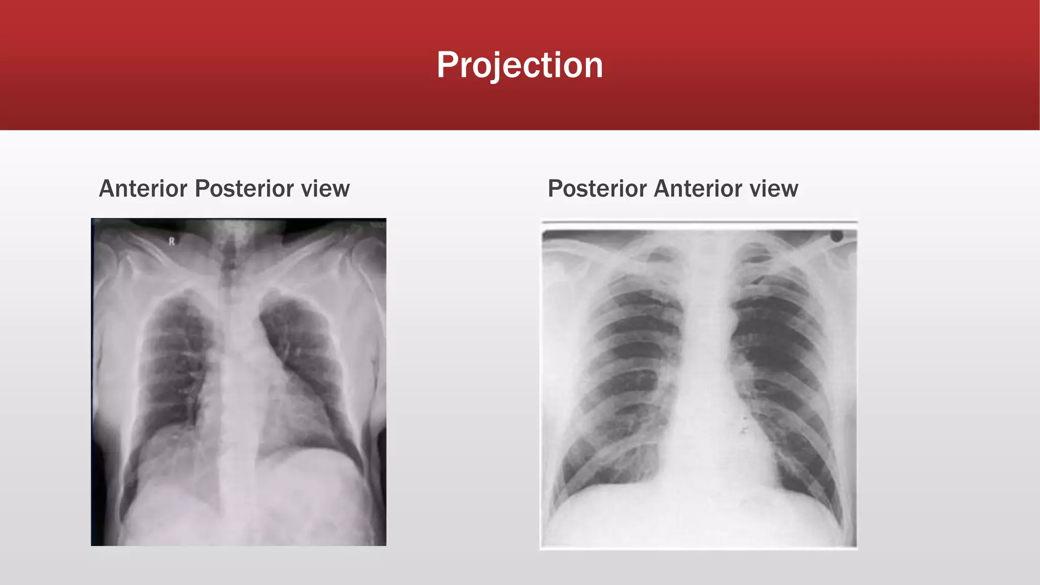 Cardiac X-ray .pptx | Lung and Respiratory Health | Diseases and Conditions