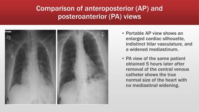 Cardiac X-ray .pptx | Lung and Respiratory Health | Diseases and Conditions