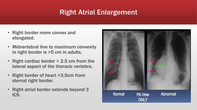 Cardiac X-ray .pptx | Lung and Respiratory Health | Diseases and Conditions