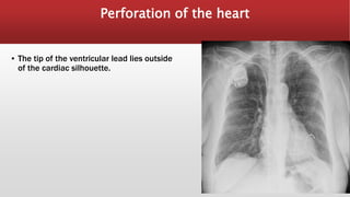 Cardiac X-ray .pptx