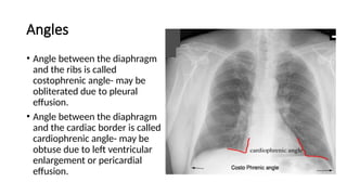 Radiographic approach to cardiac xray presentation.pptx