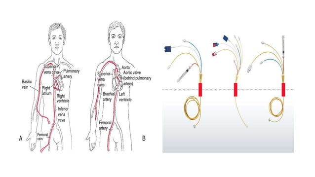Cardiac catherization | PPTX