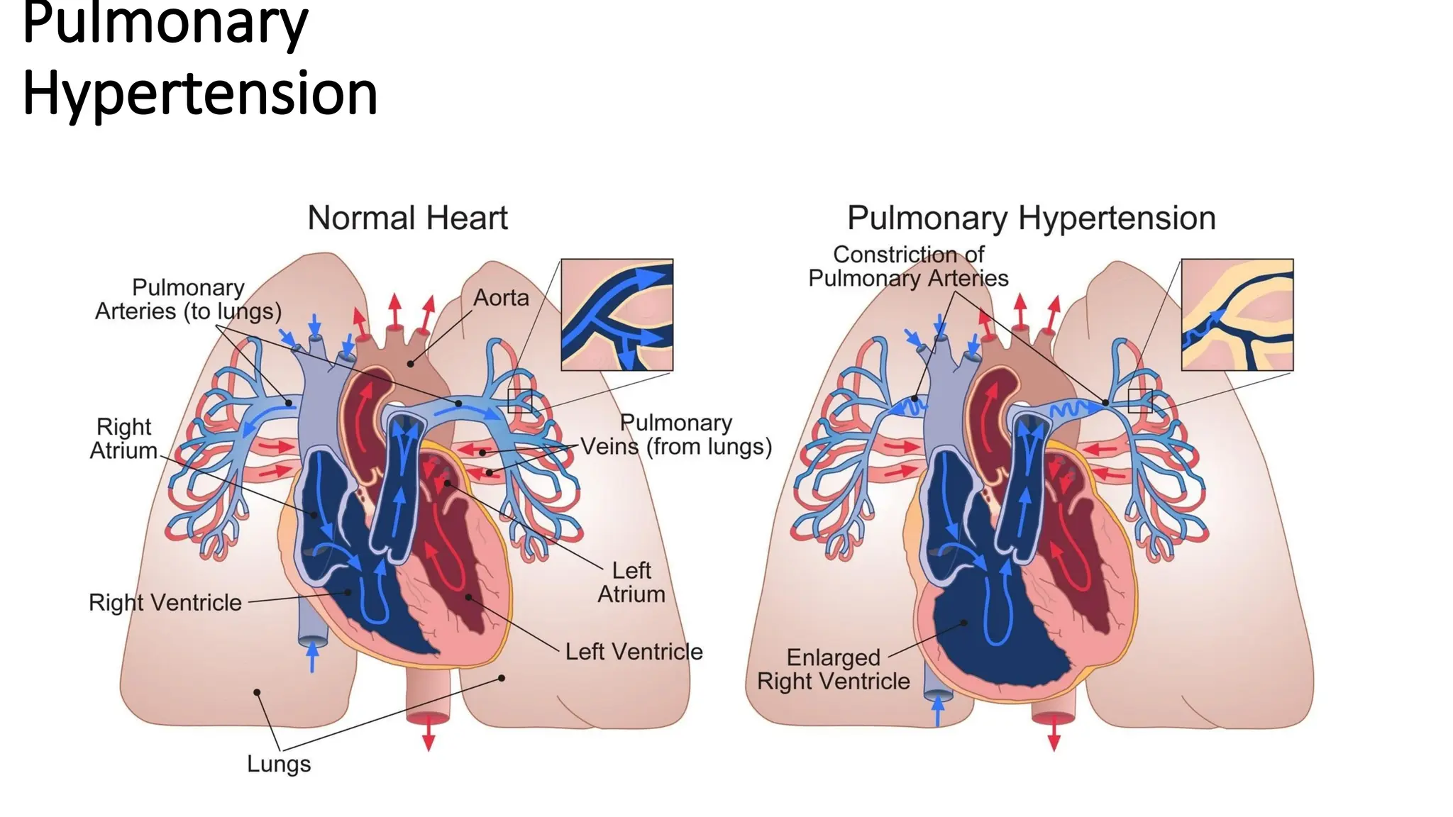 CARDIO-VASCULAR CLASS-Venous Thromboembolism Including Pulmonary ...