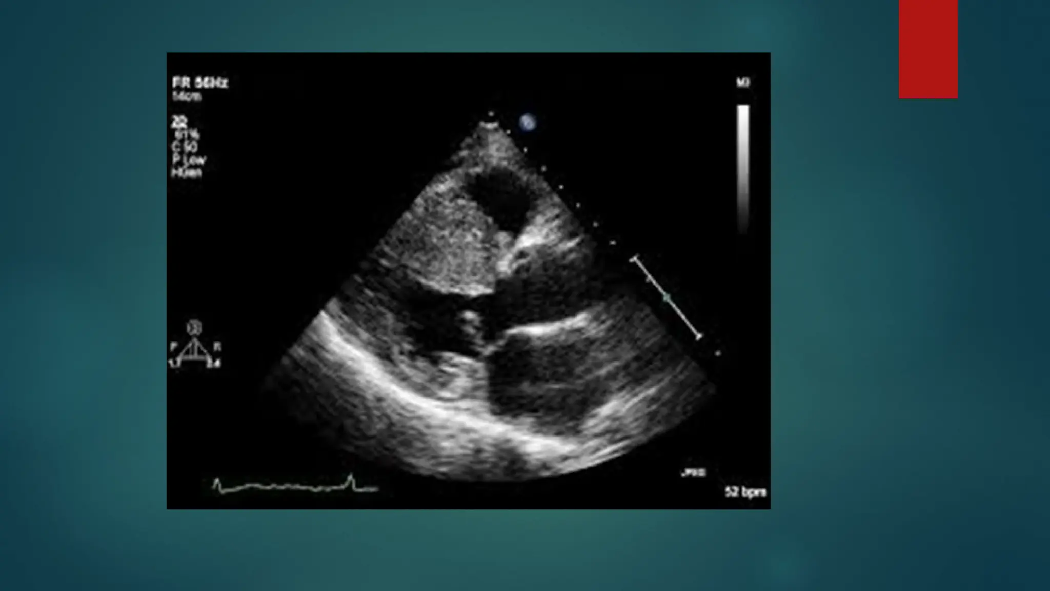 Cardio case- medicine final year exam.ppt