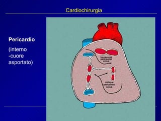 Cardiochirurgia Pericardio | PPT