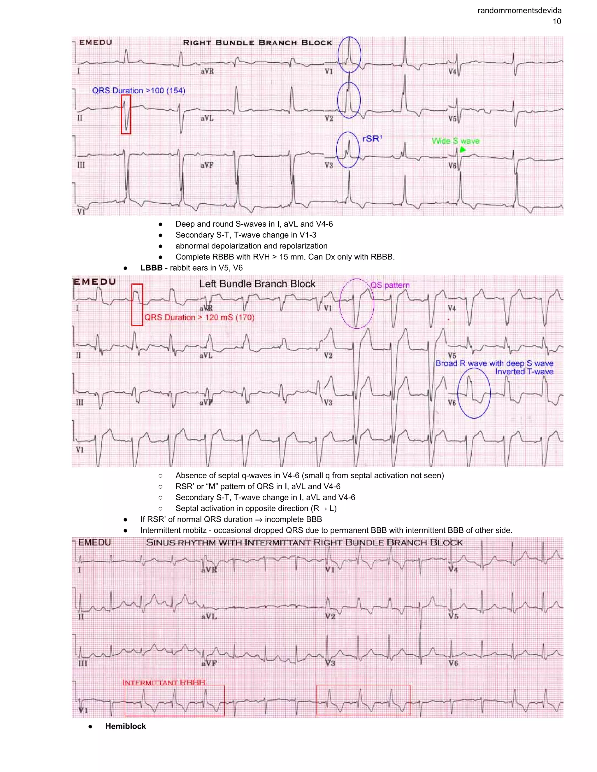 CARDIOLOGY - ECG MADE SIMPLE - HIGH YIELD USMLE | PDF