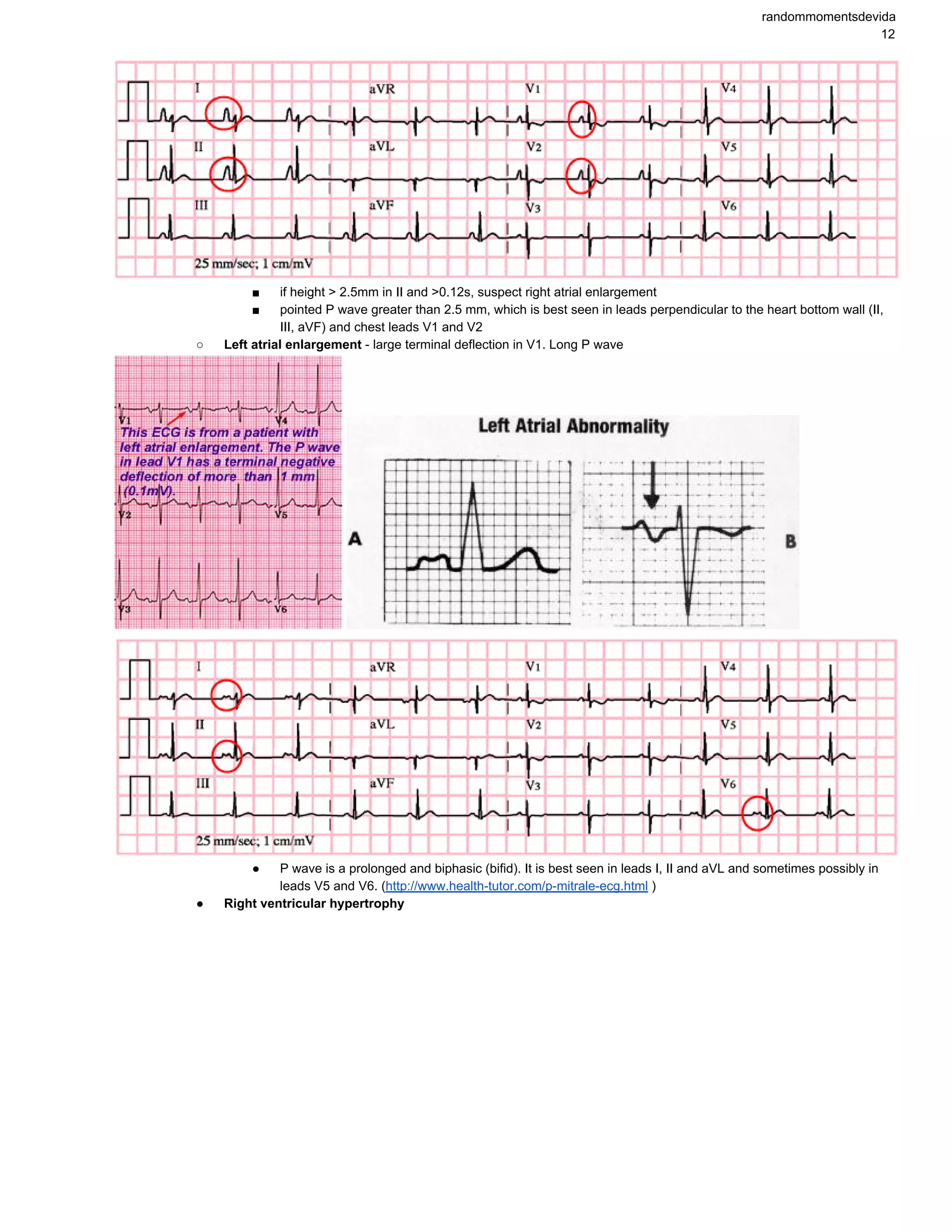 CARDIOLOGY - ECG MADE SIMPLE - HIGH YIELD USMLE | PDF