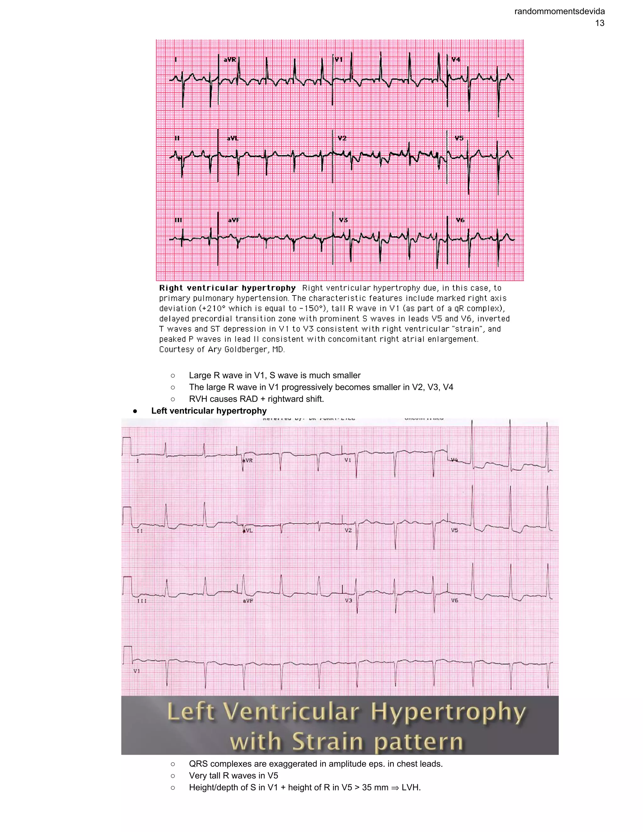 CARDIOLOGY - ECG MADE SIMPLE - HIGH YIELD USMLE | PDF