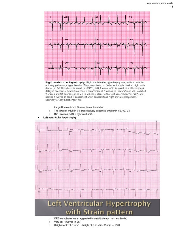 CARDIOLOGY - ECG MADE SIMPLE - HIGH YIELD USMLE | PDF | Heart and ...