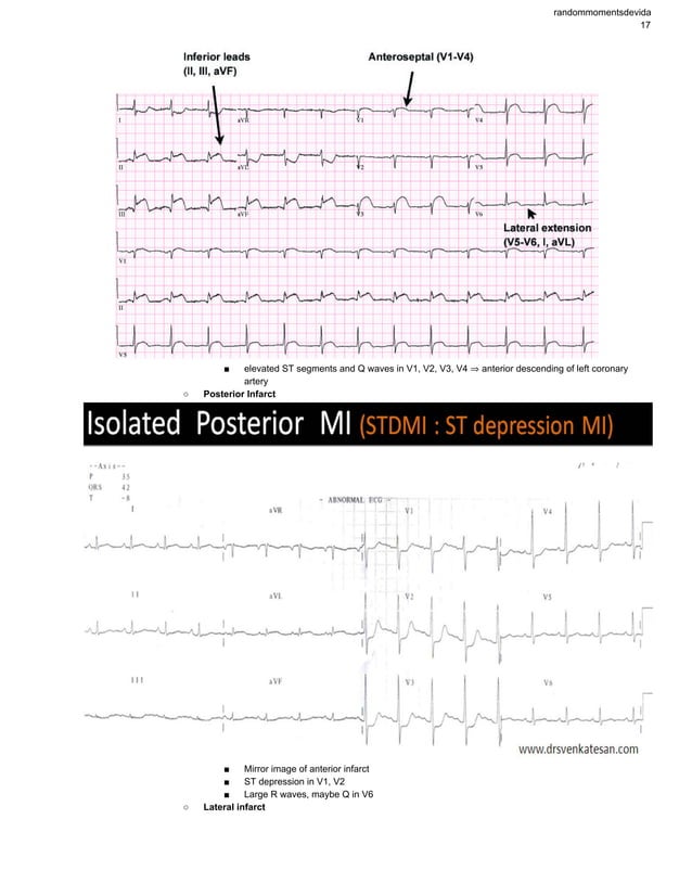 CARDIOLOGY - ECG MADE SIMPLE - HIGH YIELD USMLE | PDF | Heart and ...