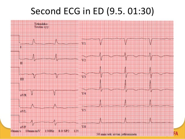Cardiogenic shock