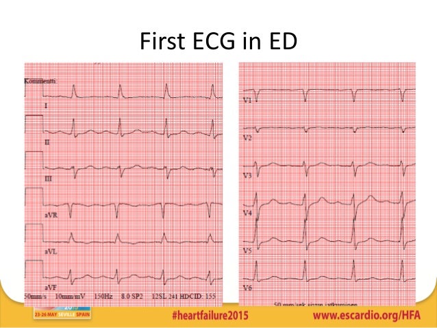 Cardiogenic shock