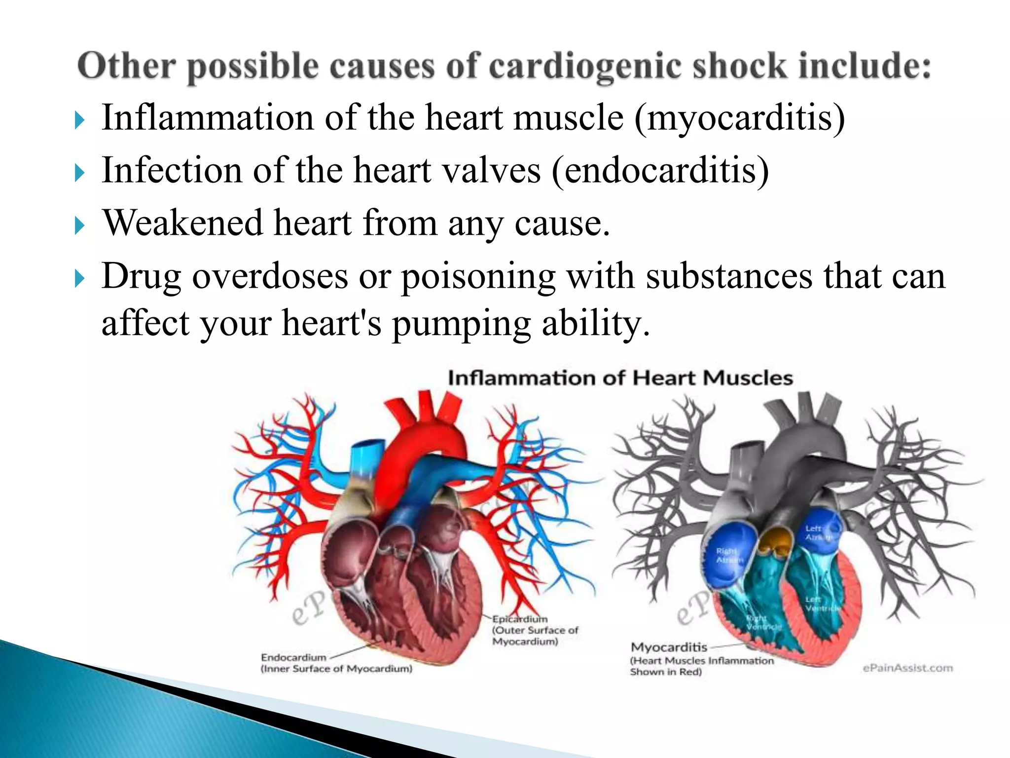 Cardiogenic shock | PPTX