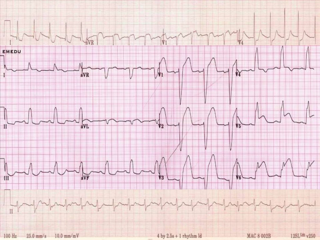 MANAGEMENT OF ANTERIOR WALL MI WITH SHOCK IN A NON PCI CENTER