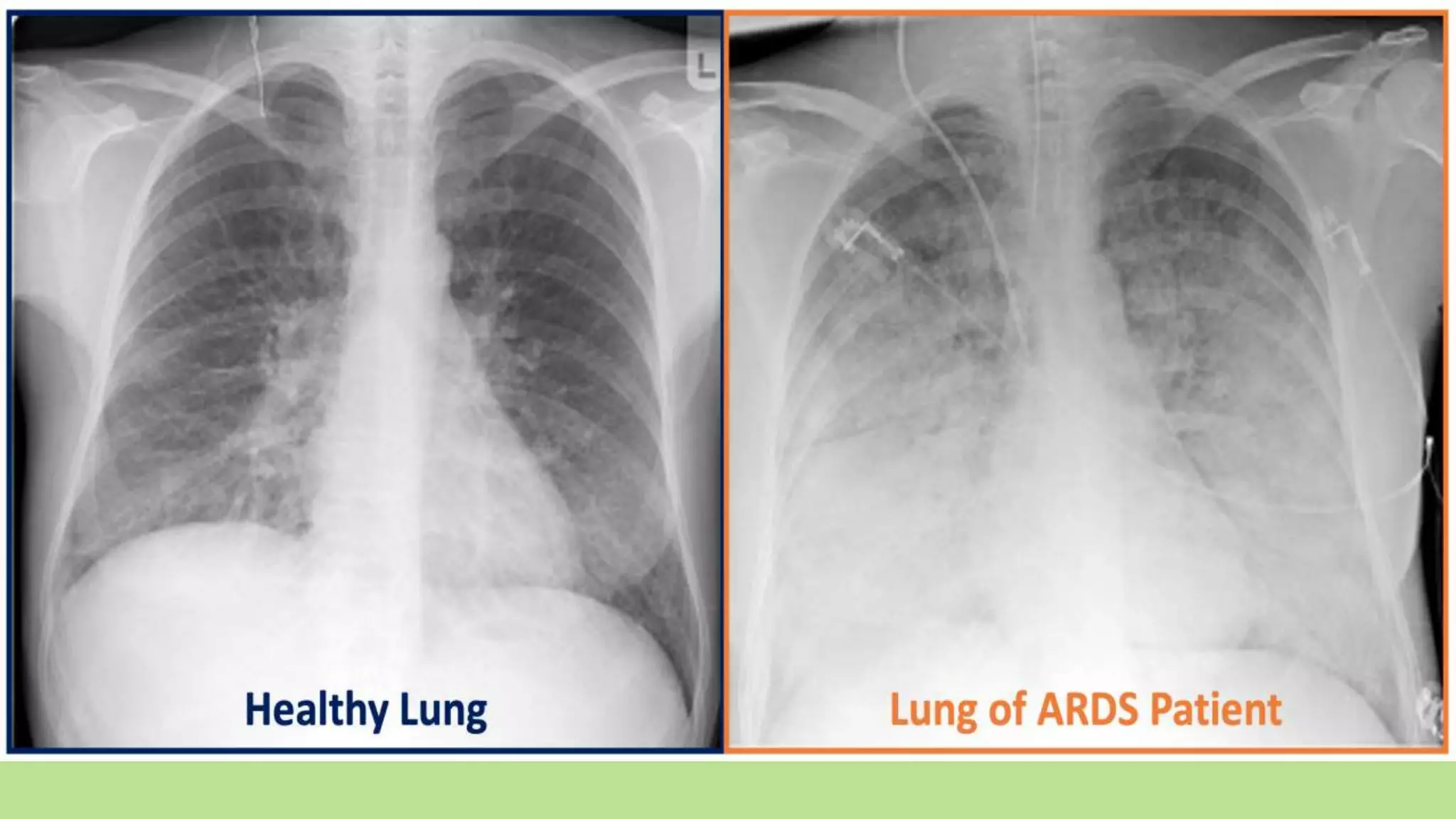 Cardiogenic vs noncardiogenic pulmonary edema (ARDs) | PPTX