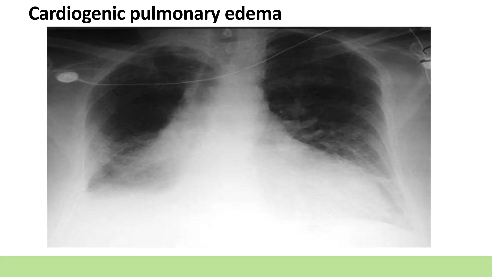 Cardiogenic vs noncardiogenic pulmonary edema (ARDs) | PPTX