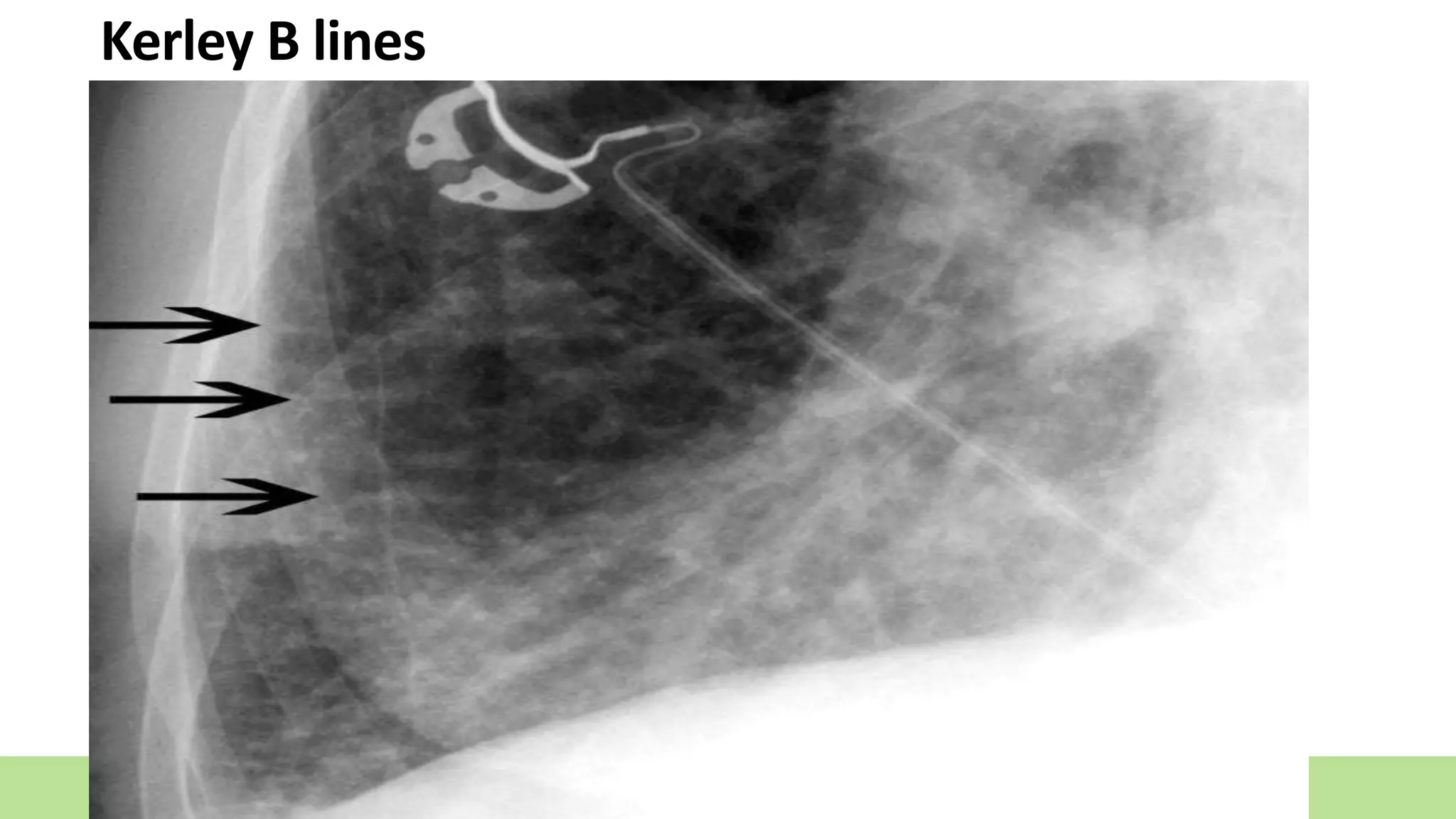 Cardiogenic vs noncardiogenic pulmonary edema (ARDs) | PPTX