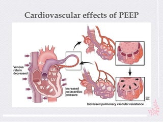 Cardiogenic shock PPV | PPTX