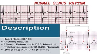 Arrhythmias (Cardiology /Cardiovascular) .pptx