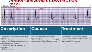 Arrhythmias (Cardiology /Cardiovascular) .pptx