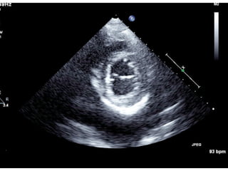 Cardiology morning presentation 2 im1962012 | PPT