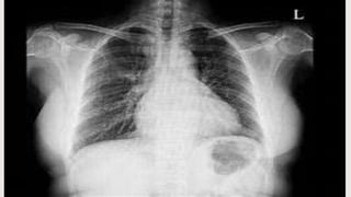 cardiomegaly-201230142934.pptx