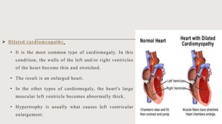 Cardiomegaly