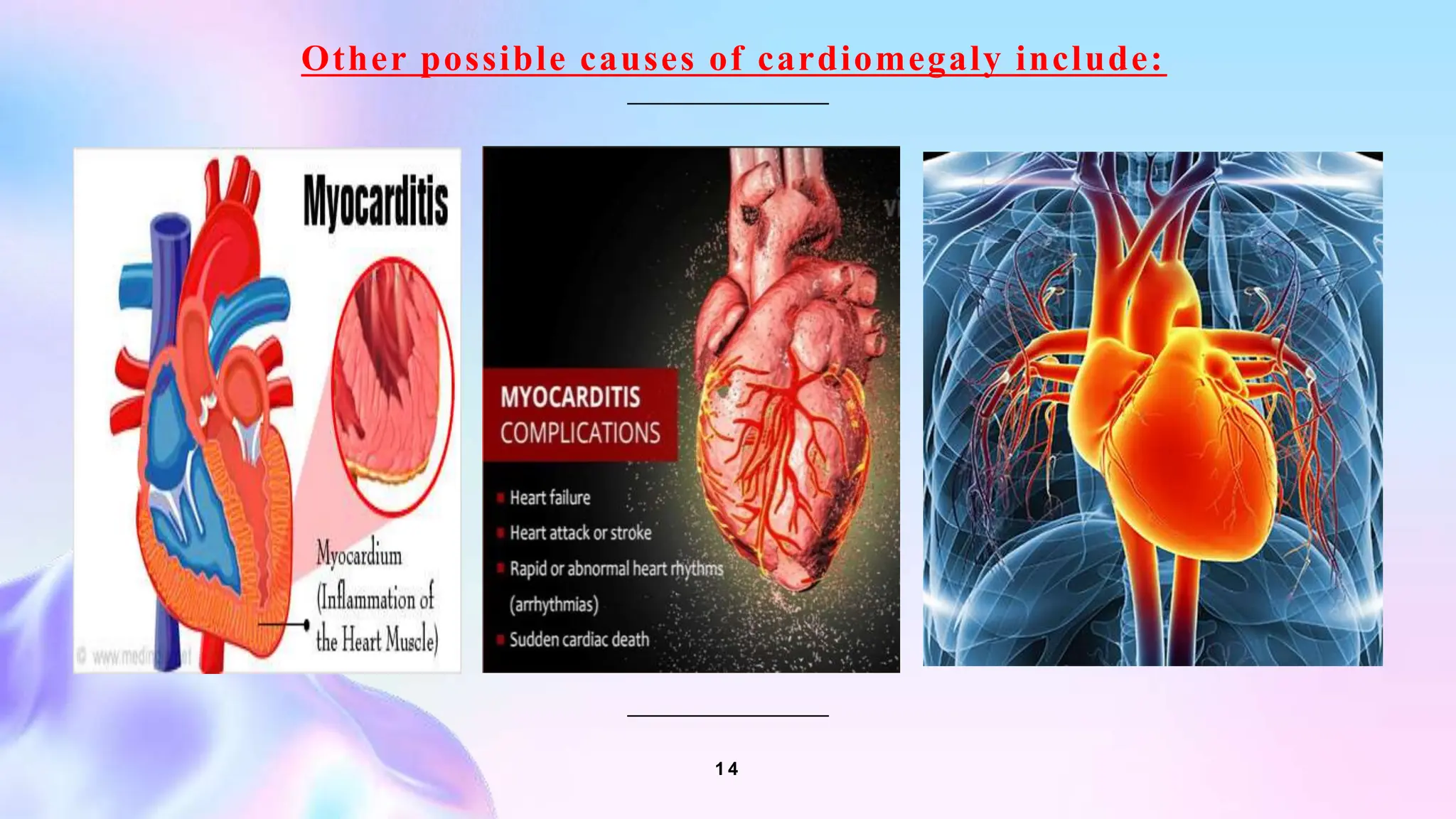 cardiomegaly.pptx, DEEPIKA.R, M. Sc nursing. | PPTX
