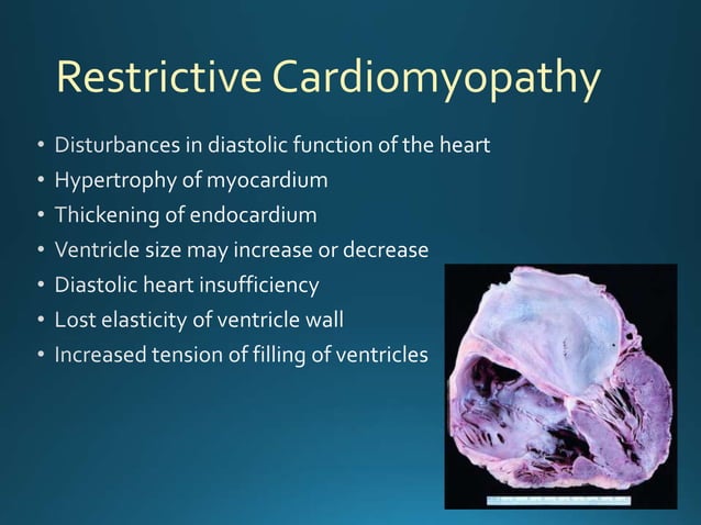 Cardiomyopathy - clinical findings | PPTX | Heart and Cardiovascular ...