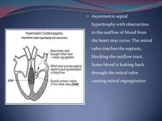 Cardiomyopathies | PPTX