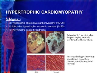 Cardiomyopathies | PPTX
