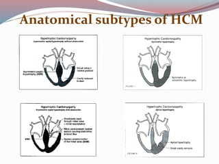 Cardiomyopathies | PPTX