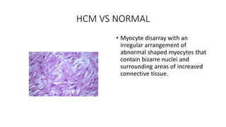 Cardiomyopathies | PPTX