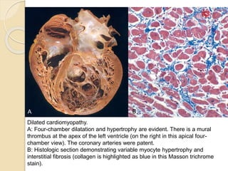 Cardiomyopathies | PPTX